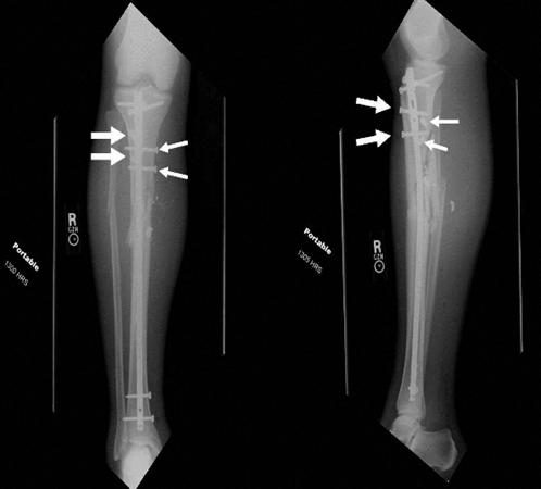 Proximal Third Tibia Fracture - Trauma - Orthobullets
